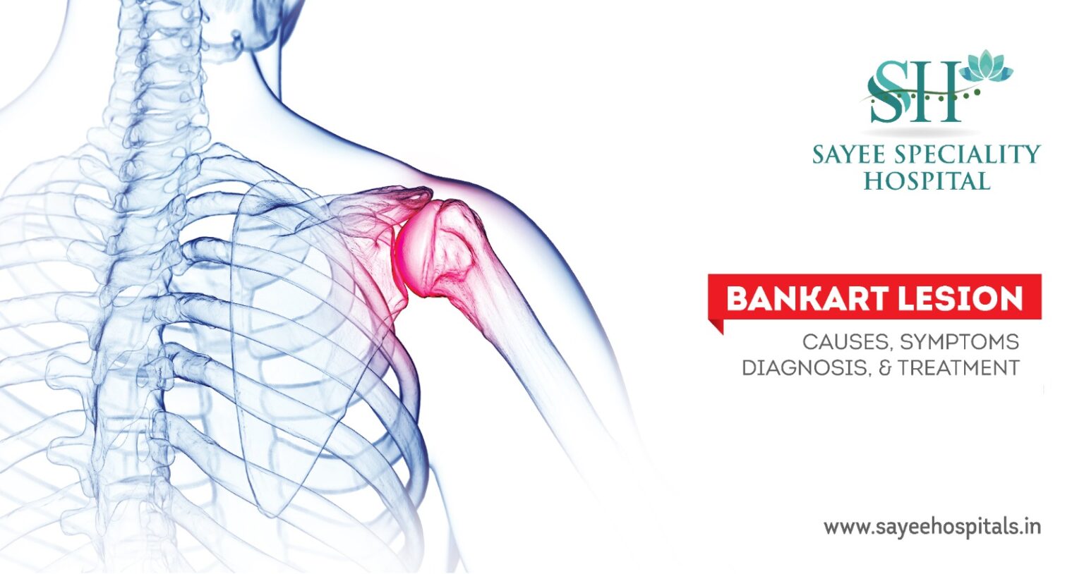 Bankart Lesion: Causes, Symptoms, Diagnosis, And Treatment - Sayeehospital