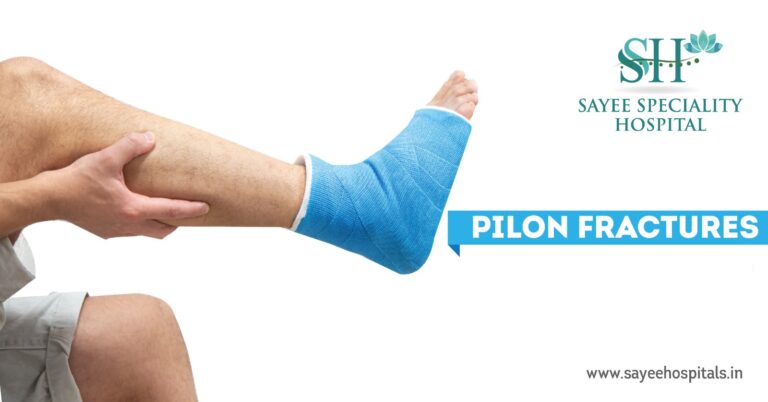 Pilon Fracture - Sayeehospital